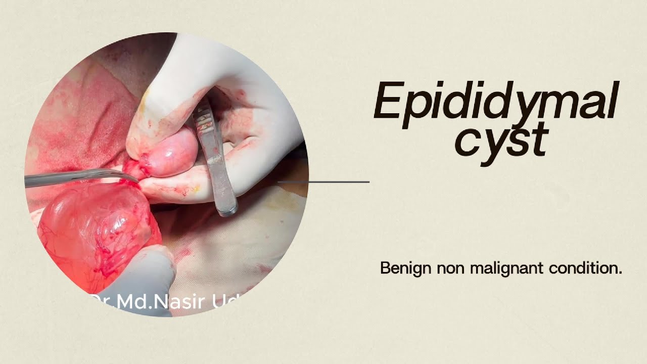 Excision of epididymal cyst./ For patient education/ Bangla. - YouTube