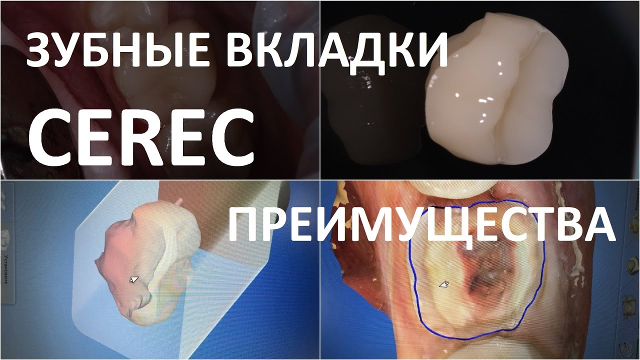 Преимущества зубных вкладок Cerec - YouTube