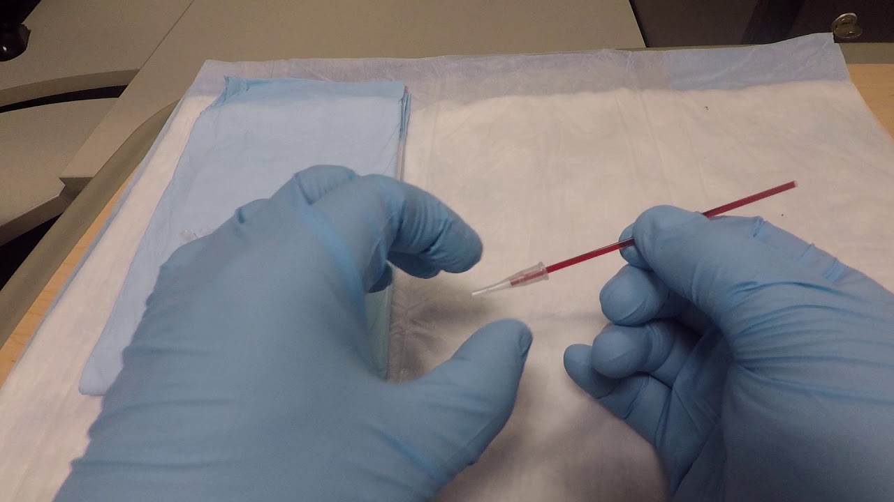 Transferring capillary sample with clot catcher, Alberta Health ...