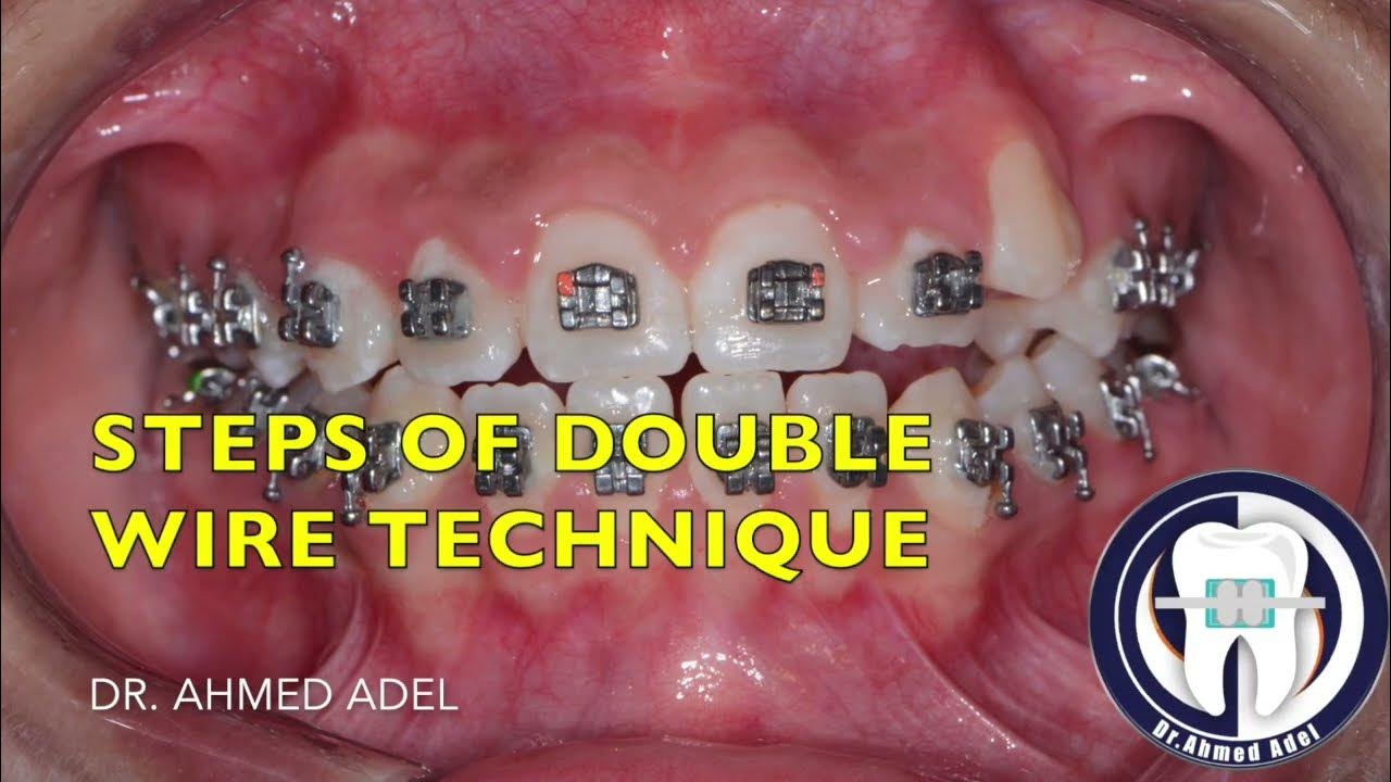 Double wire Technique - Piggy back technique - step by step - Orthodontics - YouTube