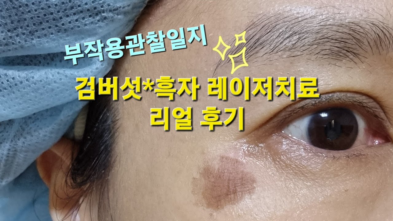 흑자검버섯 레이저치료 리얼 후기 Youtube