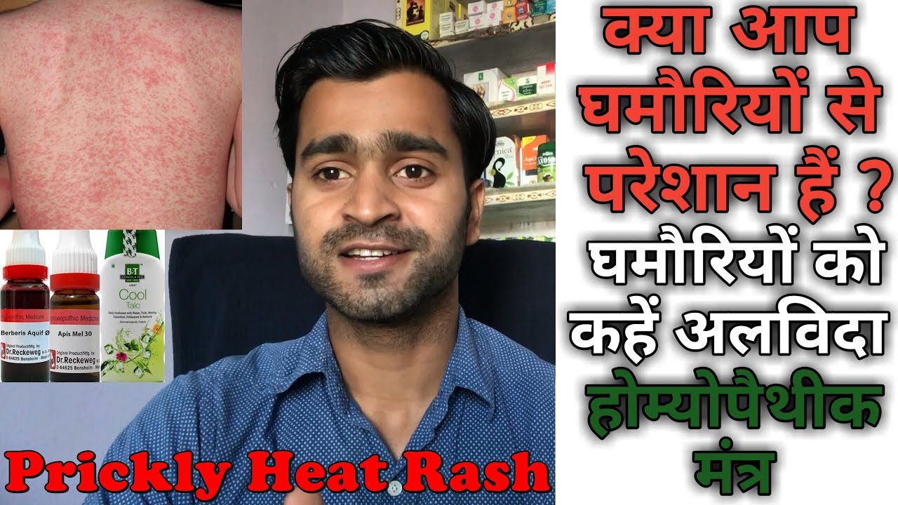 Prickly heat rash ! Ghamoriya ! Heat rash ! Prickly heat ! Homeopathic ...
