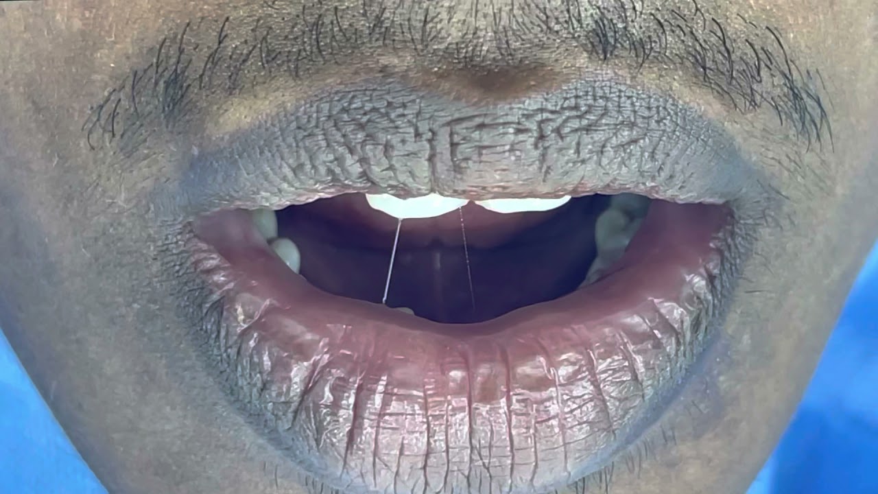 Lower lip reduction surgery to match with upper lip - YouTube