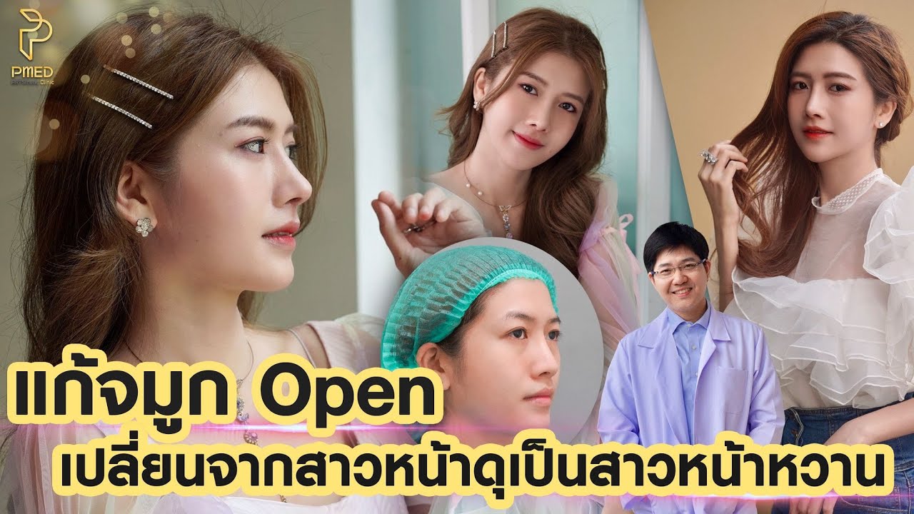 แก้จมูก ทำจมูก Open Recon สุดปัง จากสาวหน้าดุ คุณหมอต้น แก้จมูกเป็นสาว ...