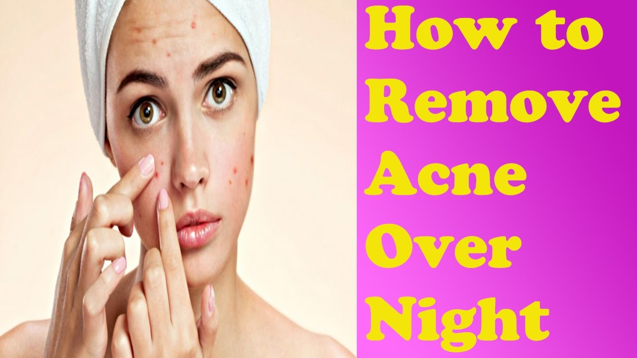 How To Remove Pimples Overnight | Acne Treatment | Home Remedies for ...