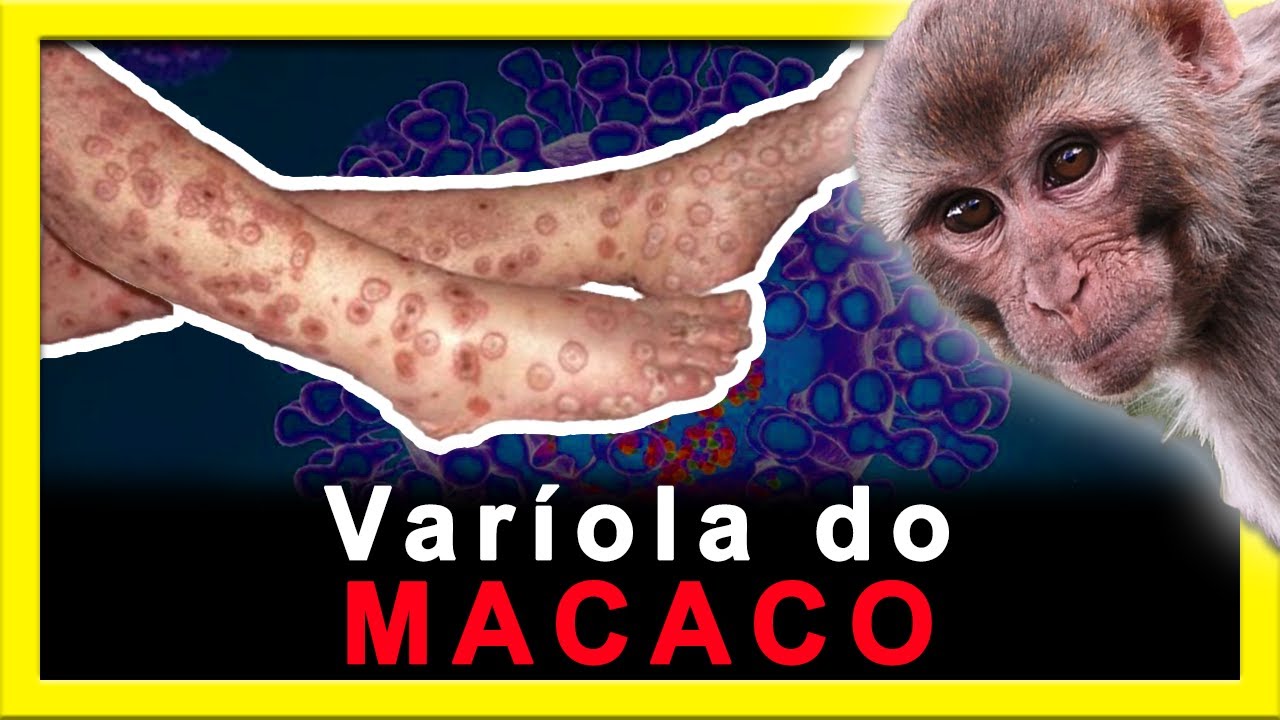 VARÍOLA DO MACACO. Mais uma doença para nos preocupar? - YouTube