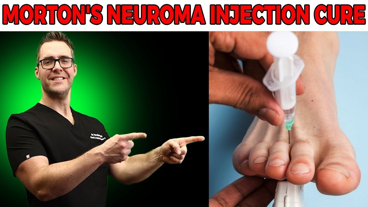 Morton's Neuroma Injection Cure? [Neuroma Cortisone Injection] - YouTube