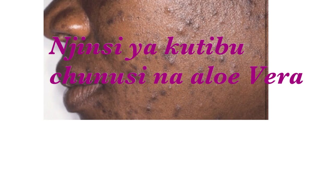 Jinsi ya kutoa chunusi na upele upele usoni - YouTube