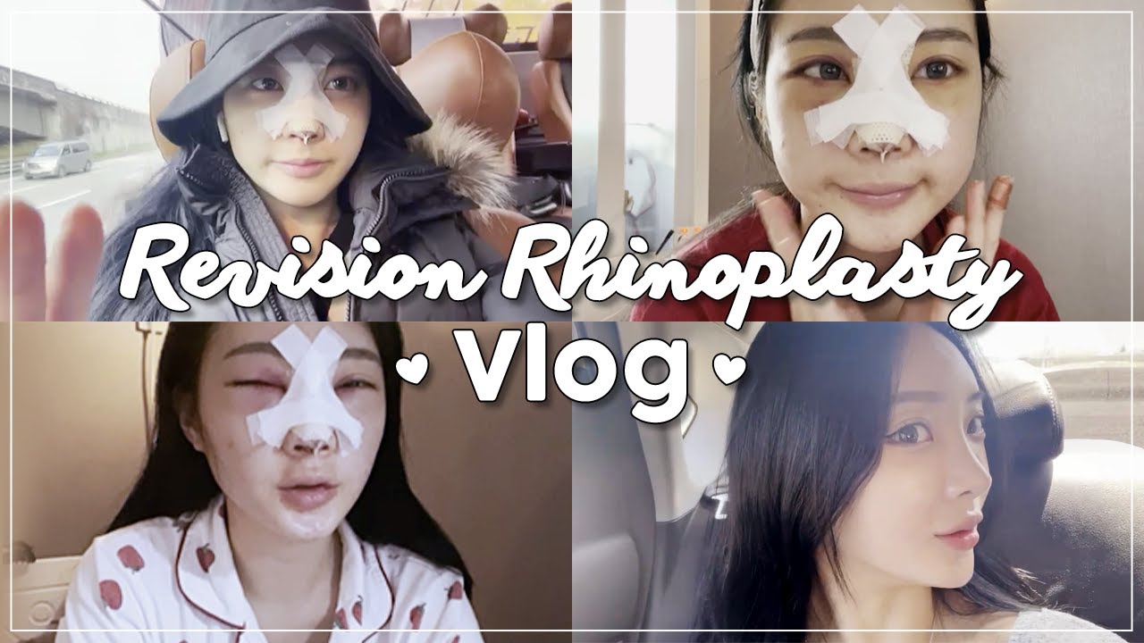 Rhinoplasty in Korea VLOG - my fight with swelling - YouTube
