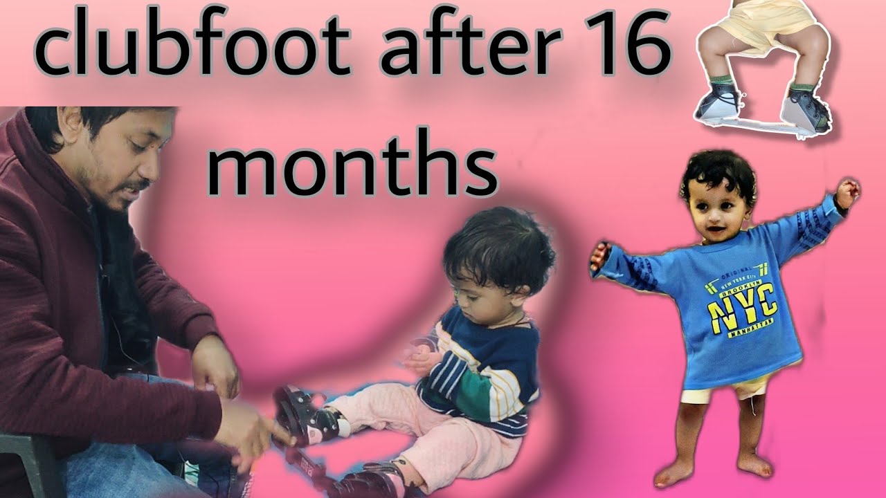 how to exercise clubfoot after 16 months baby |ctev shoes time 2024 ...
