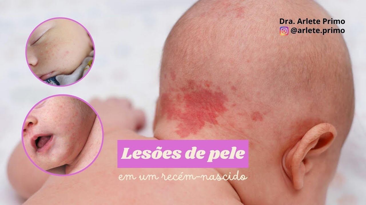 5 Lesões de pele comuns no recém nascido - YouTube