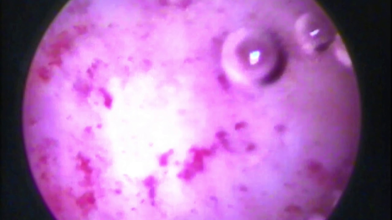 Hysteroscopic treatment of Asherman's syndrome - YouTube