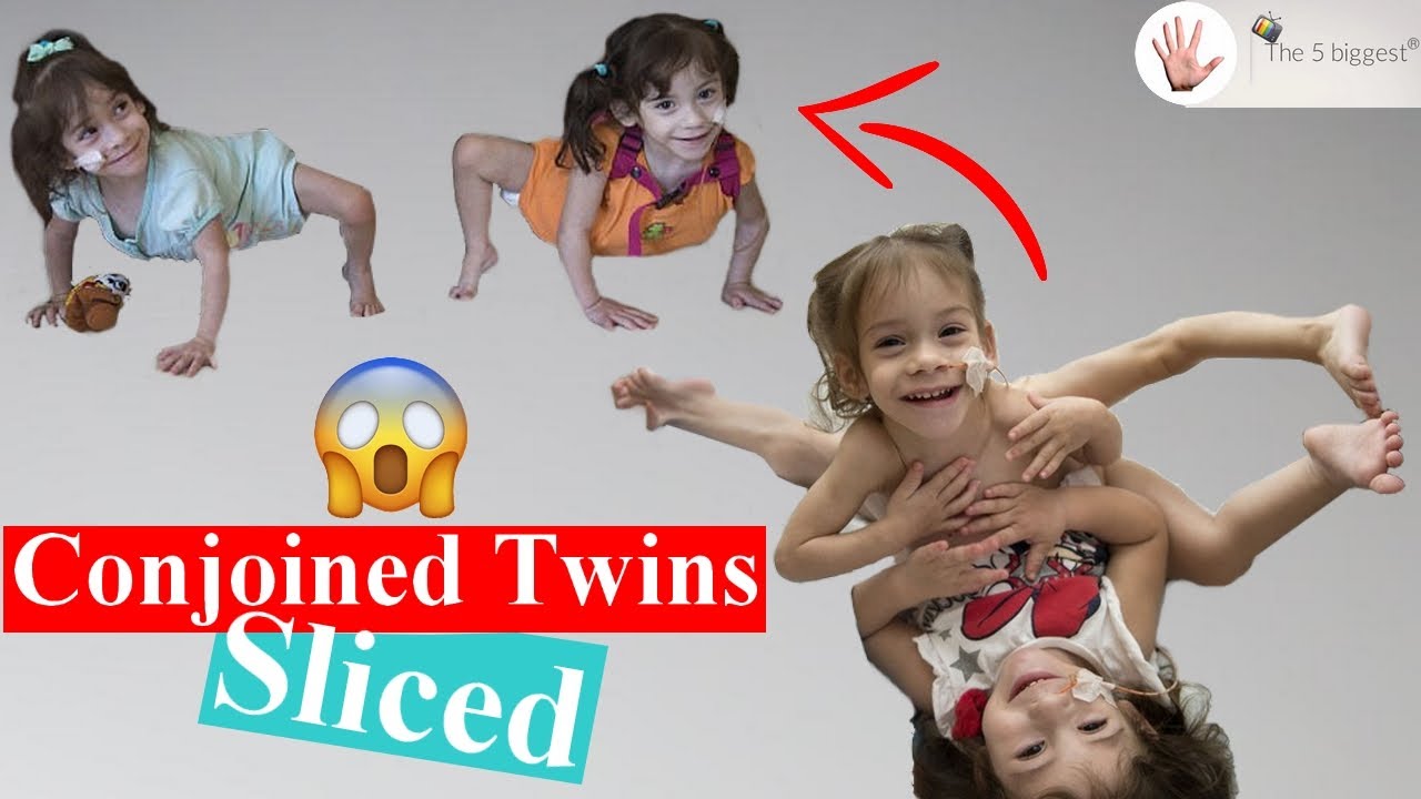 Conjoined Twins Eva and Erika: One Body Divided in Two! 🥝🔪🥝~ Body ...