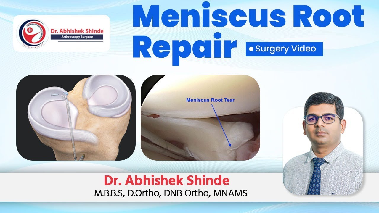 Meniscus Root Repair Surgery by Dr. Abhishek Shinde - YouTube