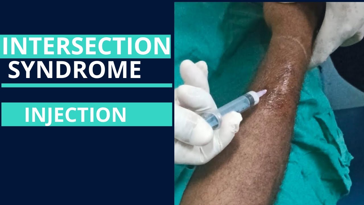 intersection syndrome - YouTube