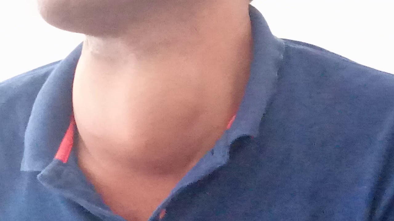 Thyroid goitre - YouTube