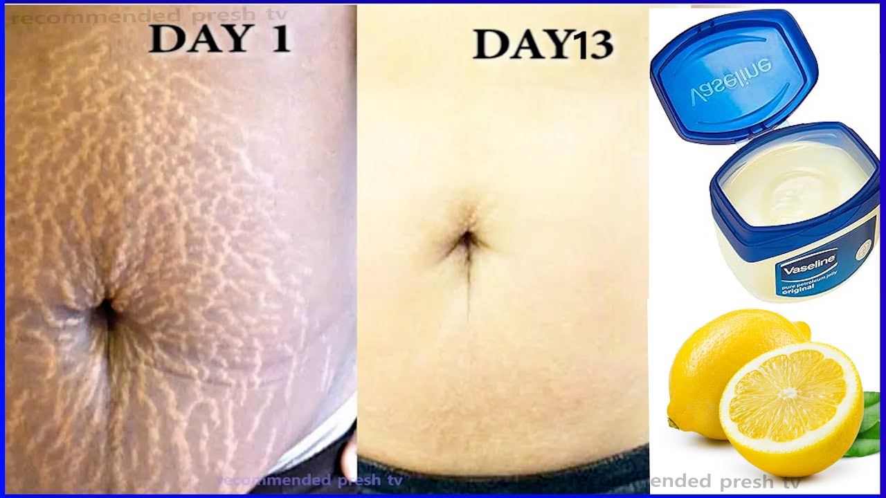Lemon remedy for stretch marks to remove stretch marks naturally at ...