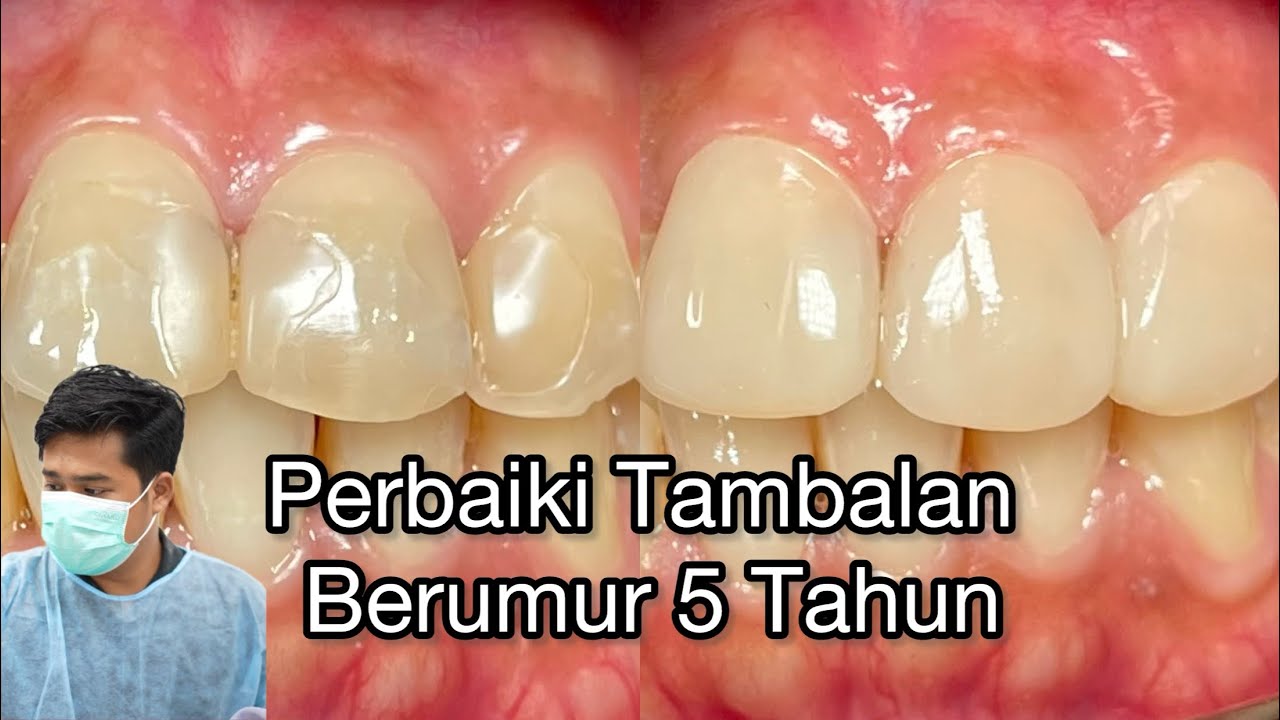 Tambalan Sudah Lama akhirnya di Retouch Ulang karena sudah berumur 5 ...