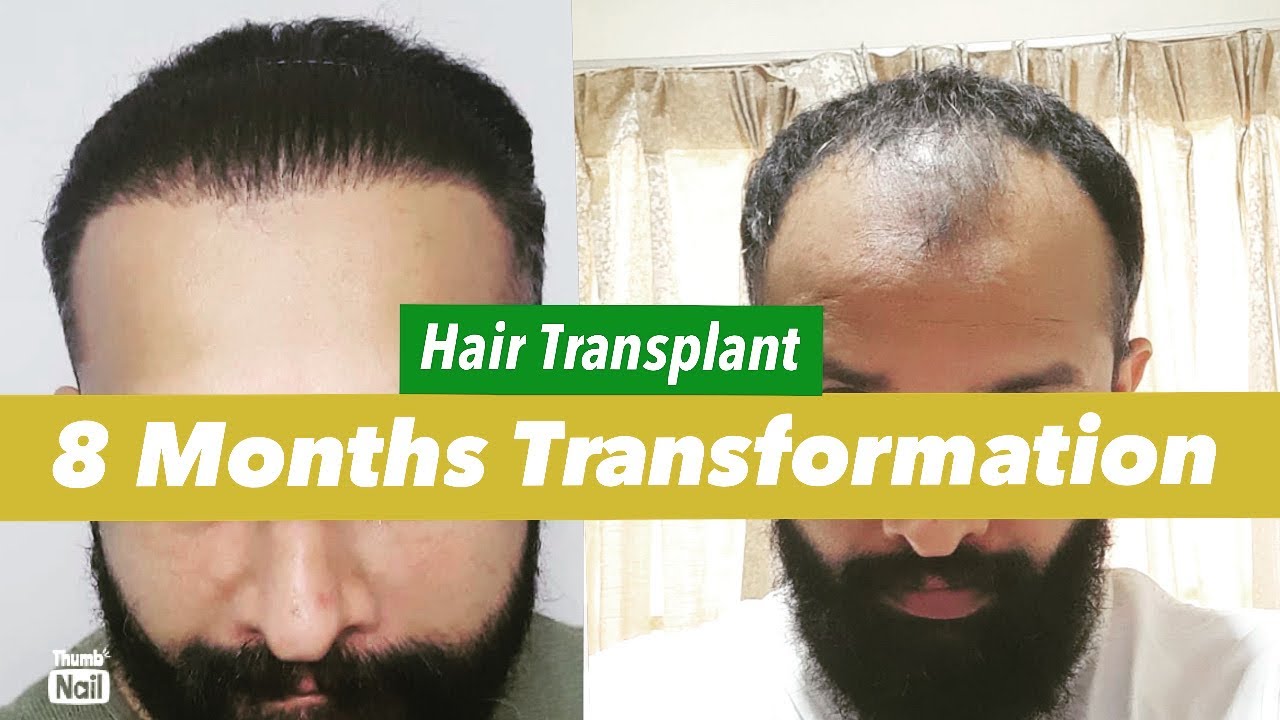 8 മാസത്തെ ഹെയർ ട്രാൻസ്‌പ്ലാന്റ് || Transformation - Step by Step ...