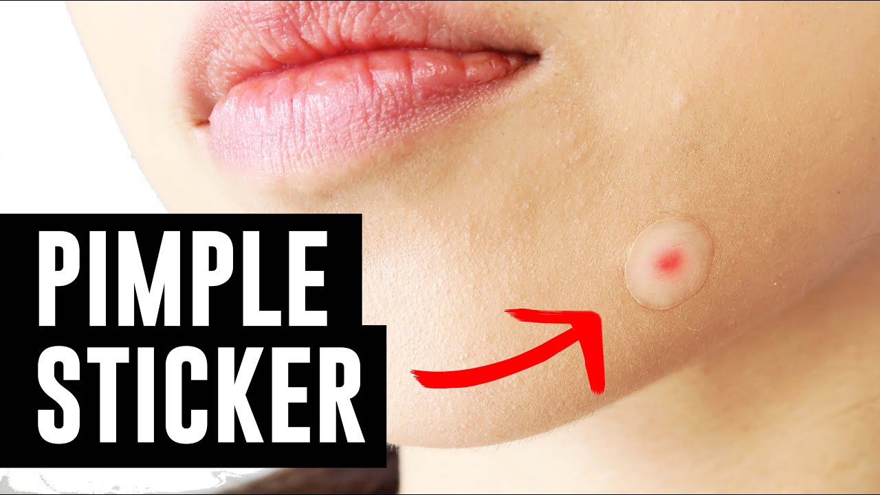 NEW ACNE TREAMENT! PIMPLE STICKER || TINA TRIES IT - YouTube