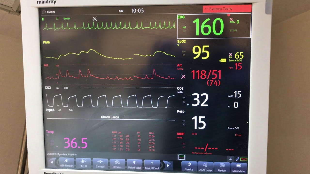 Hemodynamics of Extreme Tachycardia - YouTube