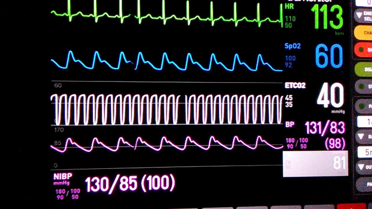 Hospital Monitor Sound Effect at David Frakes blog
