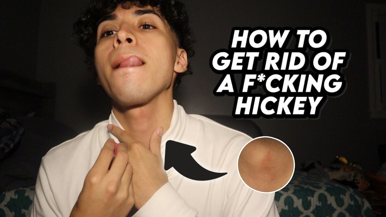 how to get rid of a hickey in 5 mins... - YouTube