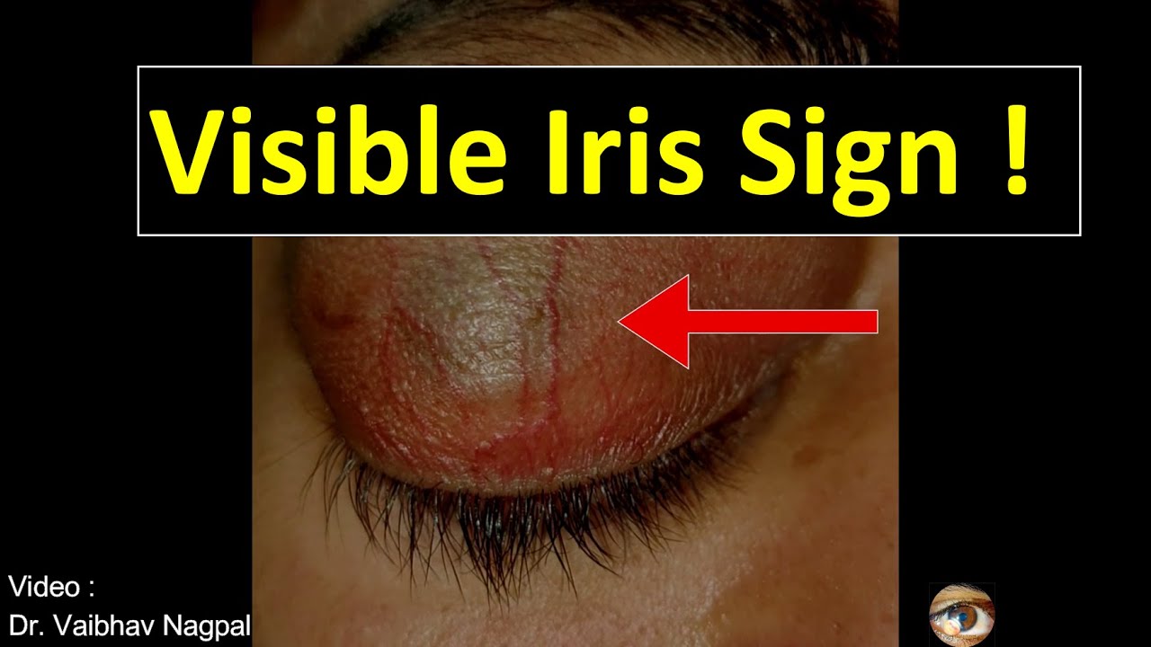 Visible iris sign - Pathology and Clinical importance : Dr. Vaibhav ...