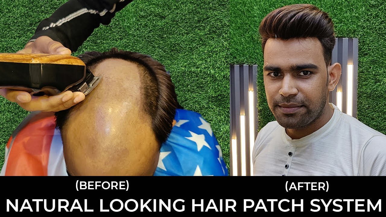Natural looking hair patch | Permanent Hair Patch Delhi | Hair patch in ...