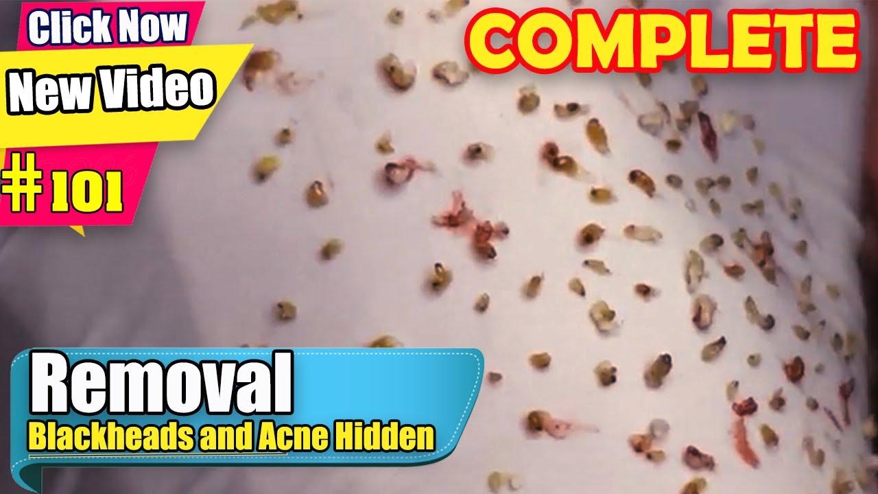 (PART) 3 COMPLETE Removal Blackheads, Acne Hidden Under Skin Clients ...