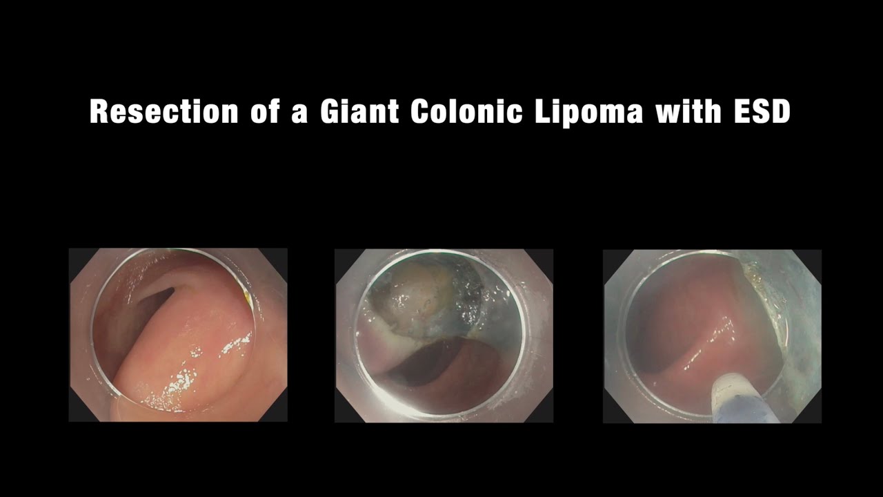 Resection of a GIANT colonic lipoma with ESD. - YouTube