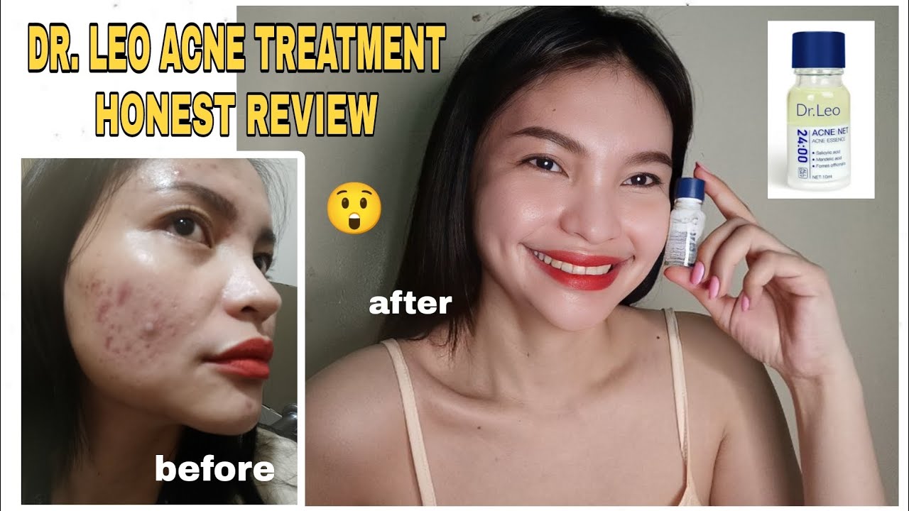 DR. LEO ACNE TREATMENT HONEST REVIEW 2024 - YouTube