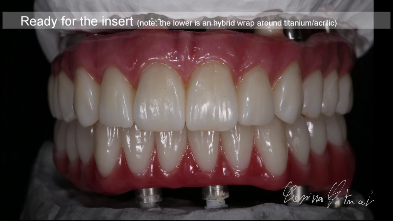 Implant Fixed Bridge Codes