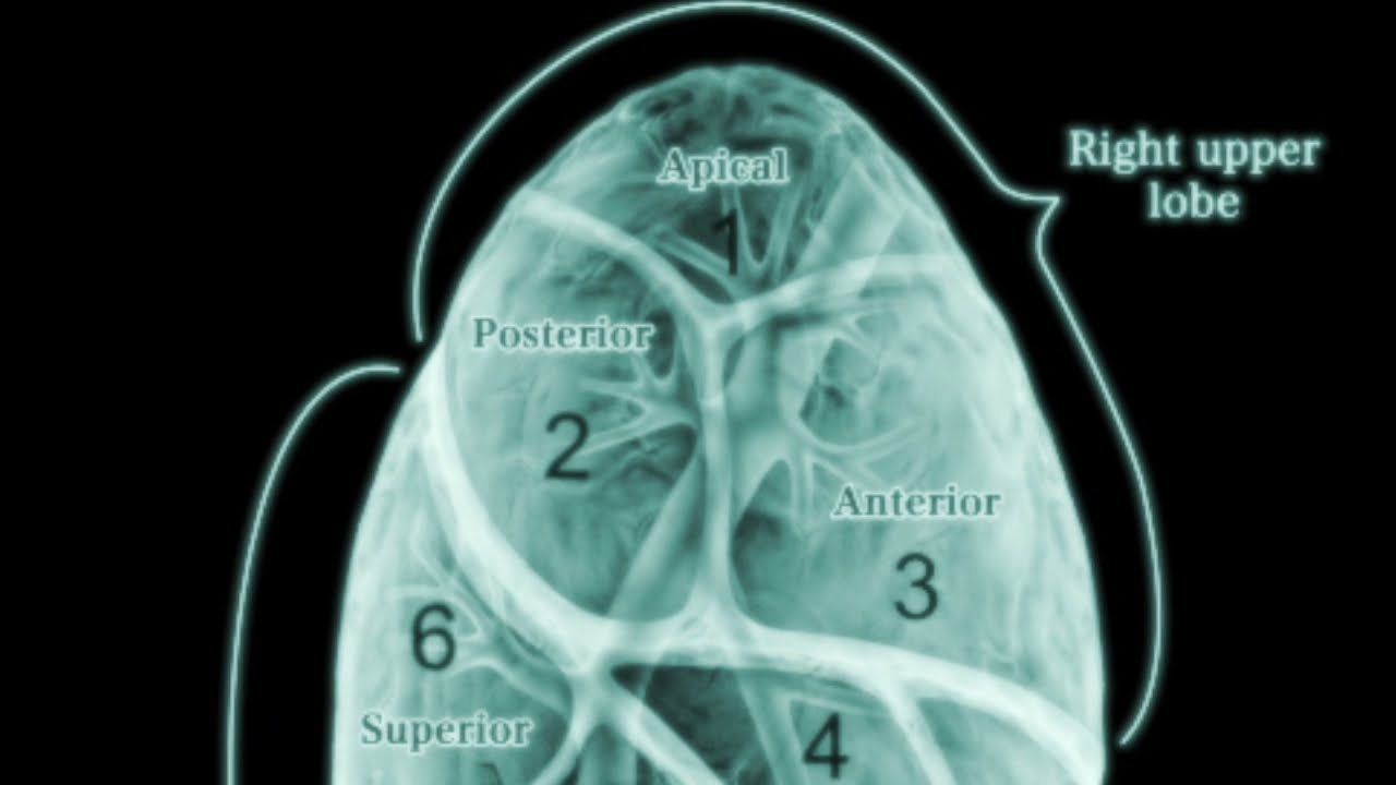 S1 Robotic Segmentectomy (RUL Apical Segment) - YouTube