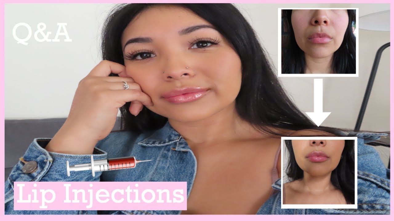 FIRST TIME LIP INJECTIONS EXPERIENCE + Q&A + Before&After - YouTube