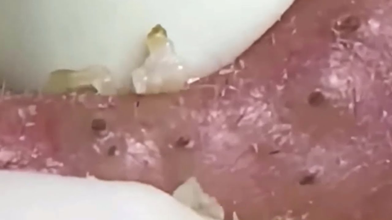 Satisfying Acne and Pimple Removal Blackheads & Whiteheads #1444 - YouTube