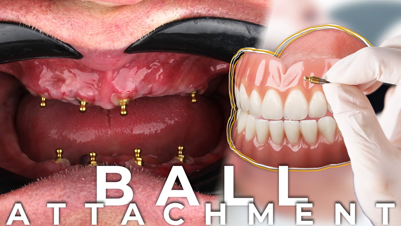 Ball Attachment Dentures / Dental Wise Turkey - YouTube