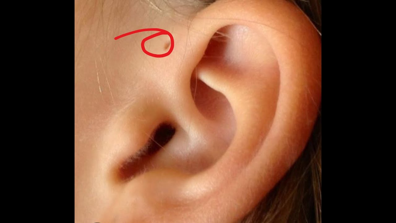 The Unusual Ear Anomaly You Wish You Had (Preauricular Ear Pit) - YouTube
