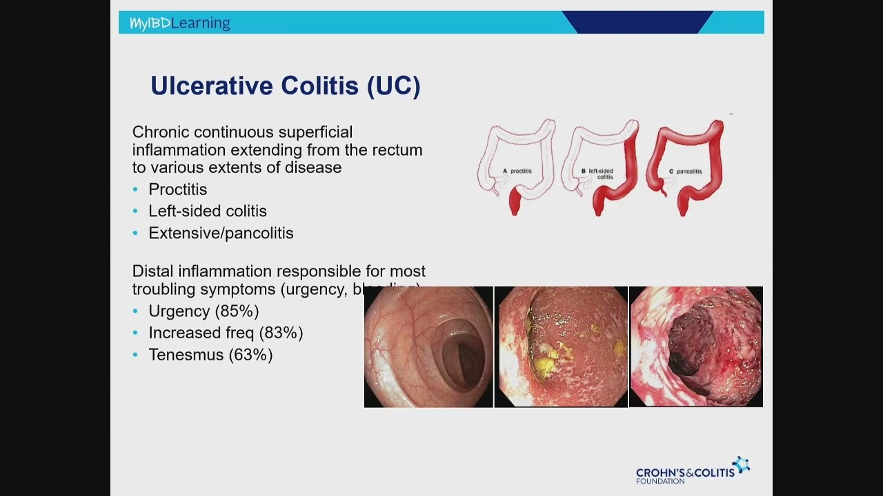 IBD 101: An Overview of Inflammatory Bowel Disease - YouTube