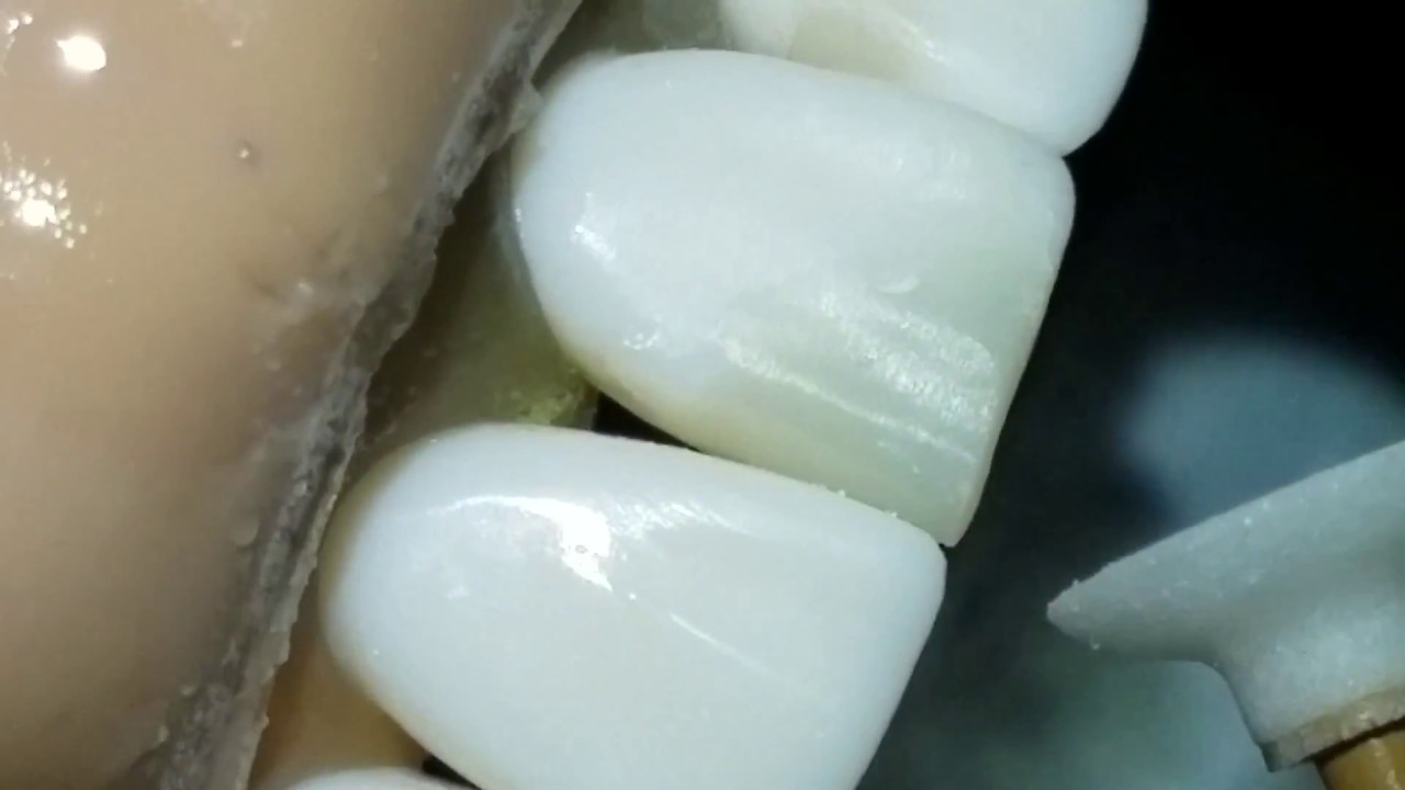 How To - Class IV Composite on #9 - YouTube