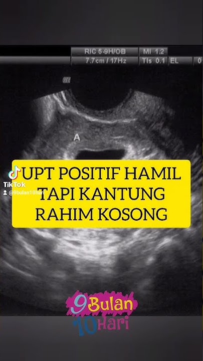 UPT positif hamil tapi kantung rahim kosong - YouTube UPT positif hamil tapi kantung rahim kosong - YouTube