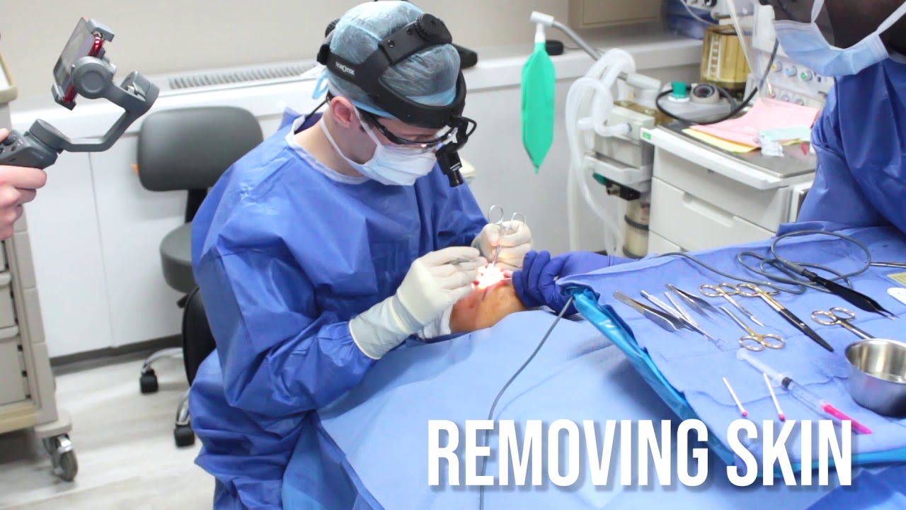 Nyc Upper Lip Lift Ues Lip Lift Surgery Facial Plastic Surgeon Dr Gary Linkov Youtube
