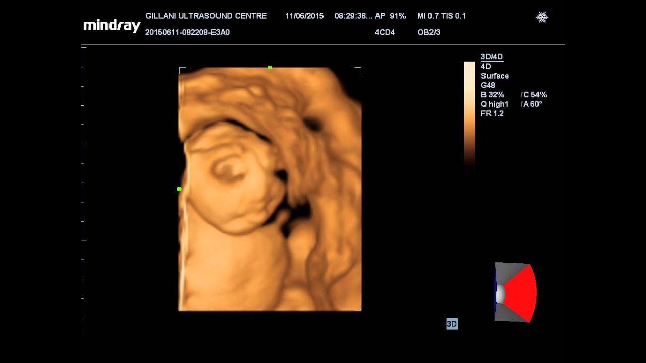 #Anencephaly - YouTube