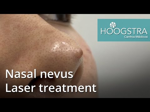 Nasal nevus laser treatment (21059) - YouTube