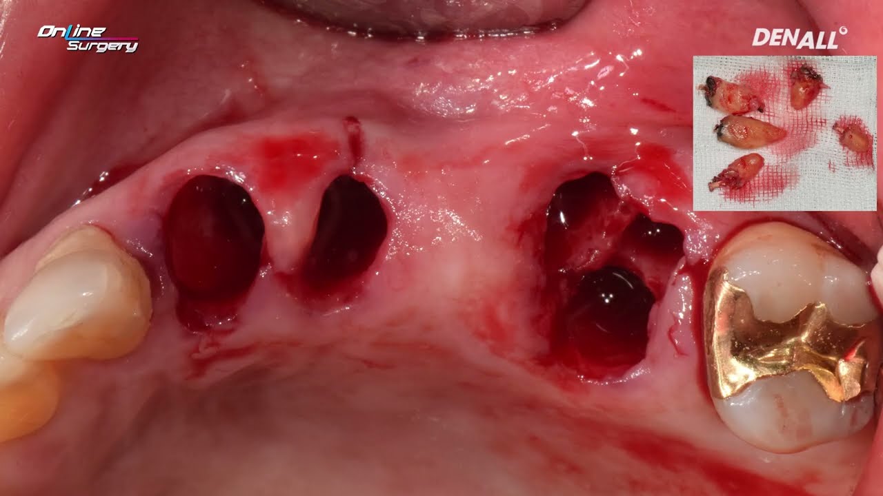[Online Surgery] Immediate placement(#23, #24, #26) using OneGuide ...