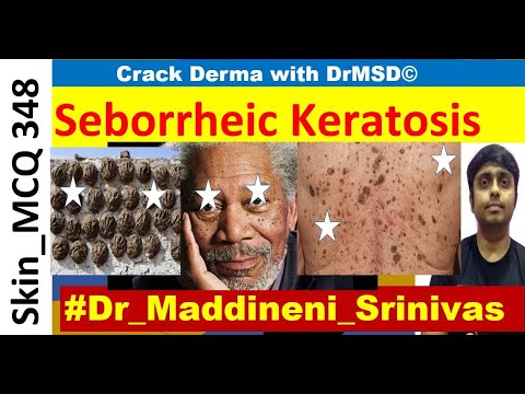 SEBORRHEIC KERATOSIS | Lesar Trelat Sign | Visceral Tumor | Elderly ...