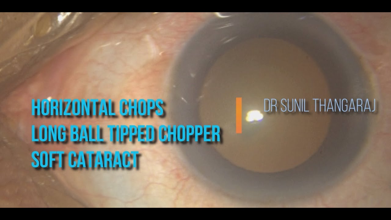 Horizontal chopping in soft cataracts - most reliable technique with 2. ...