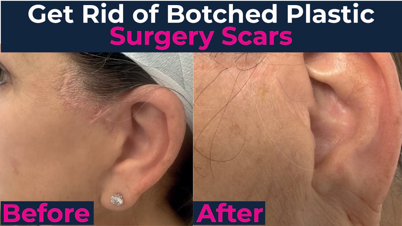 How to get rid of Botched Facelfit Scars - YouTube