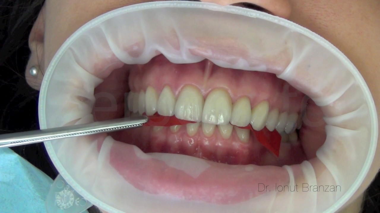 Checking lateral and protrusive movements with 40 microns paper - YouTube