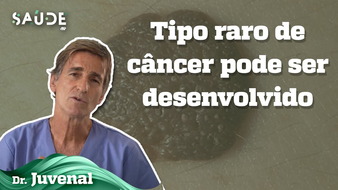 O que é nevus piloso e como é feito seu tratamento? | Dr. Juvenal - YouTube